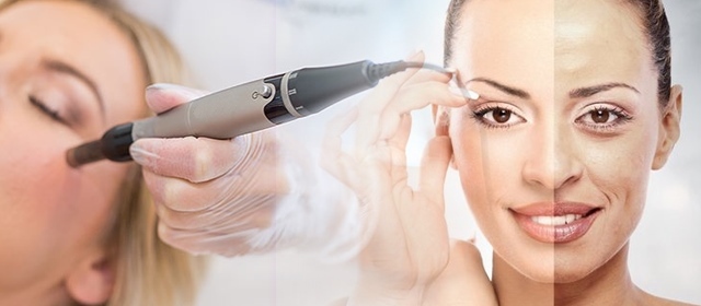 Ispeglajte bore uz prirodni botox BOTOPEPTIDE! Iglična mezoterapija ...